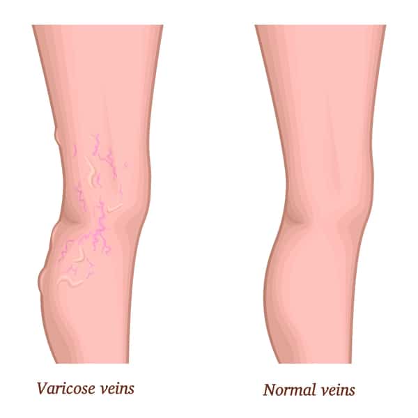 Venų varikozė: ar yra būdas išgydyti 2019 ? (Ekspertų nuomonė) - vvspt.lt